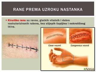 Rana i cijeljenje rane | PPSX