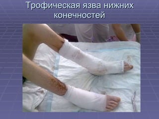 Трофическая язва | PPT