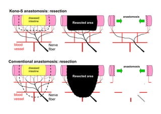 Crohn's disase | PDF