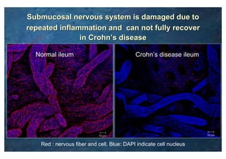 Crohn's disase | PDF
