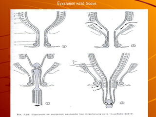 συγγενές μεγάκολο | PPT