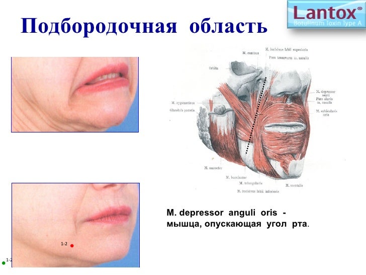 Препарат Лантокс - ботулотоксин типа А