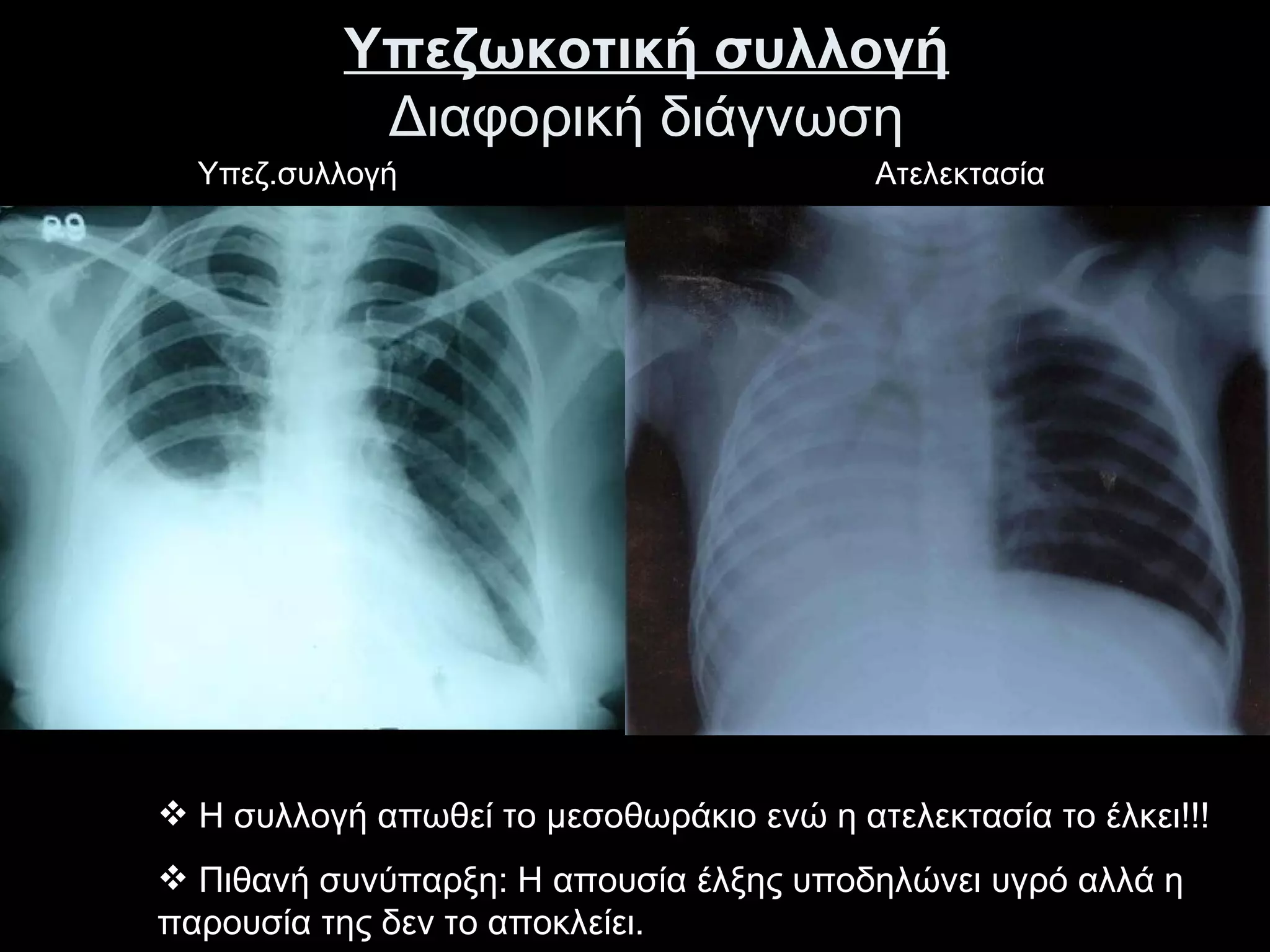 Eρμηνεία ακτινογραφίας θώρακος | PPT