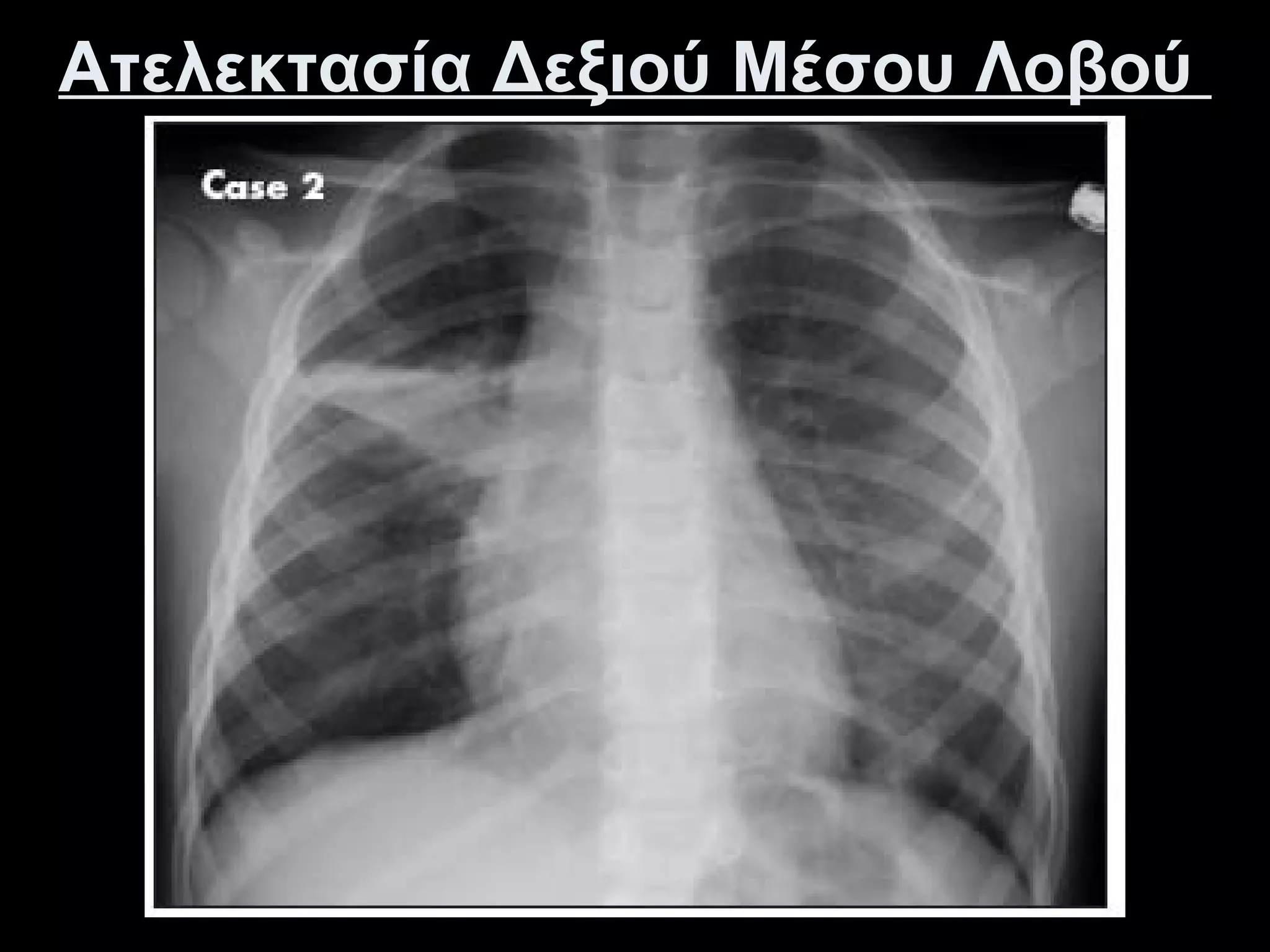 Eρμηνεία ακτινογραφίας θώρακος | PPT