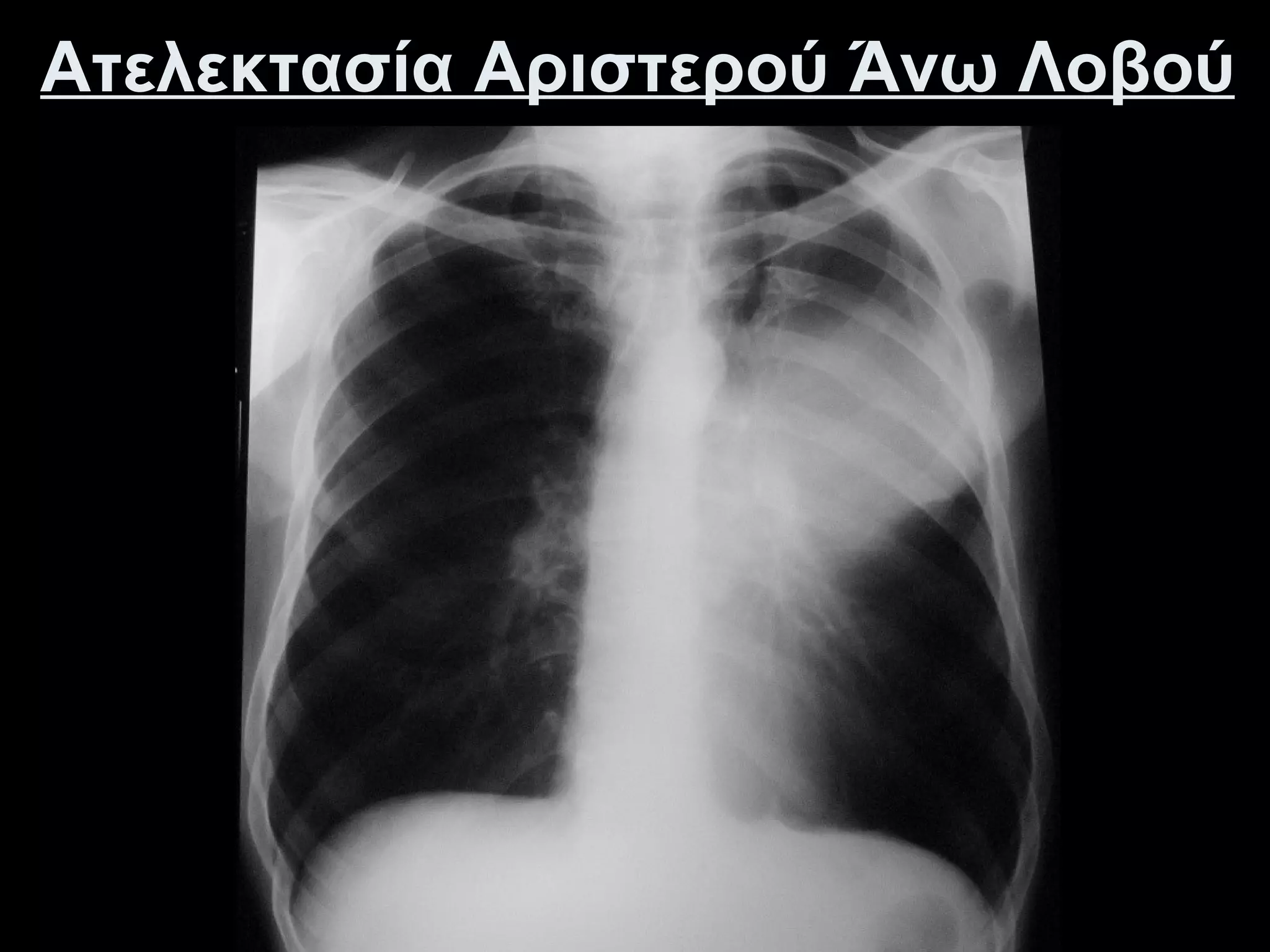 Eρμηνεία ακτινογραφίας θώρακος | PPT