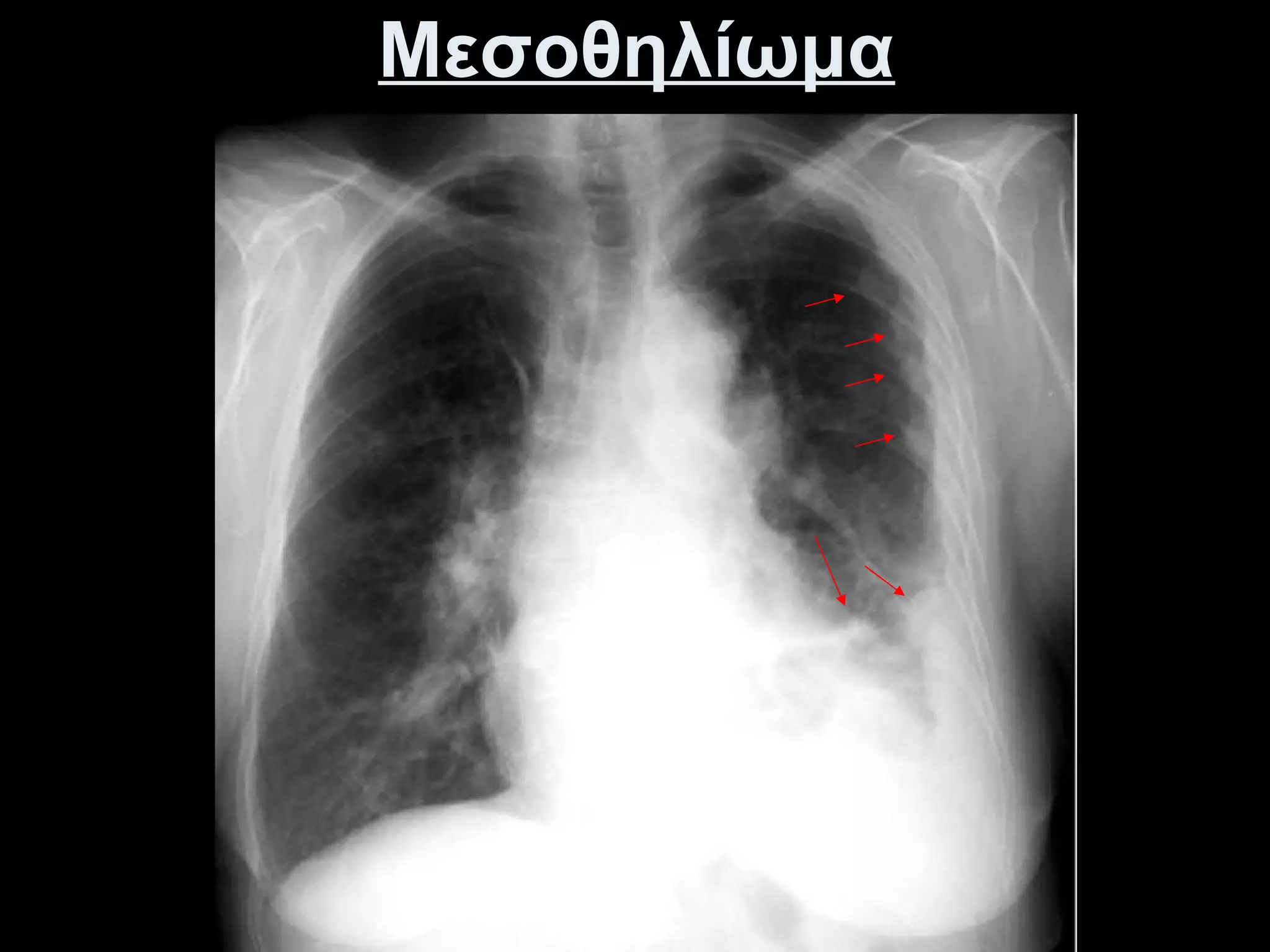 Eρμηνεία ακτινογραφίας θώρακος | PPT