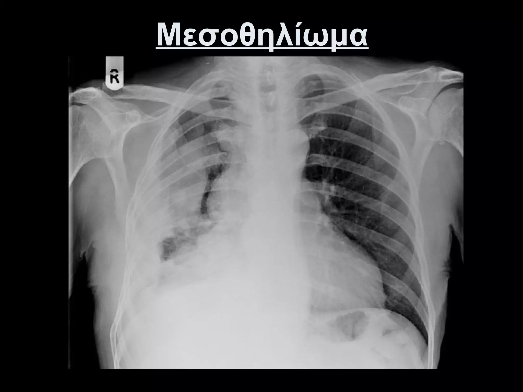 Eρμηνεία ακτινογραφίας θώρακος | PPT