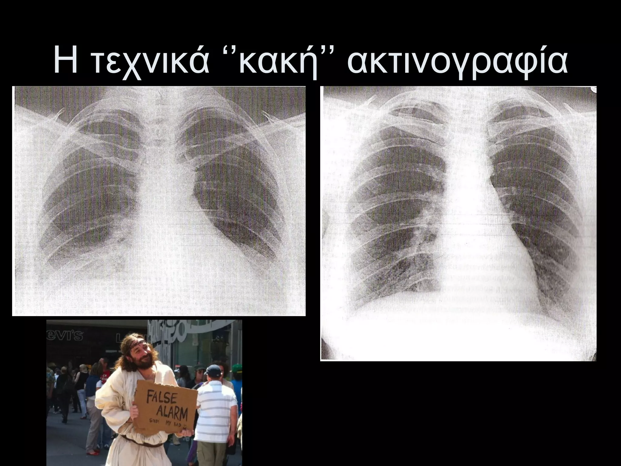 Eρμηνεία ακτινογραφίας θώρακος | PPT