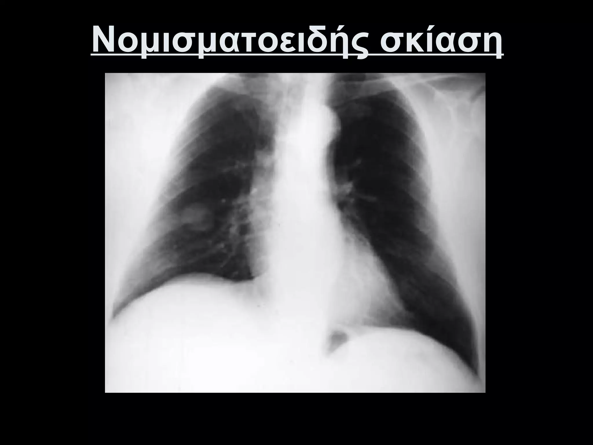 Eρμηνεία ακτινογραφίας θώρακος | PPT