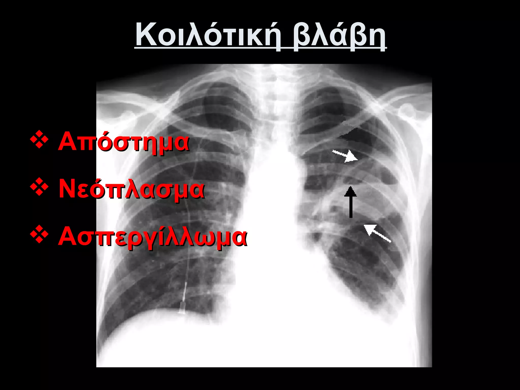 Eρμηνεία ακτινογραφίας θώρακος | PPT