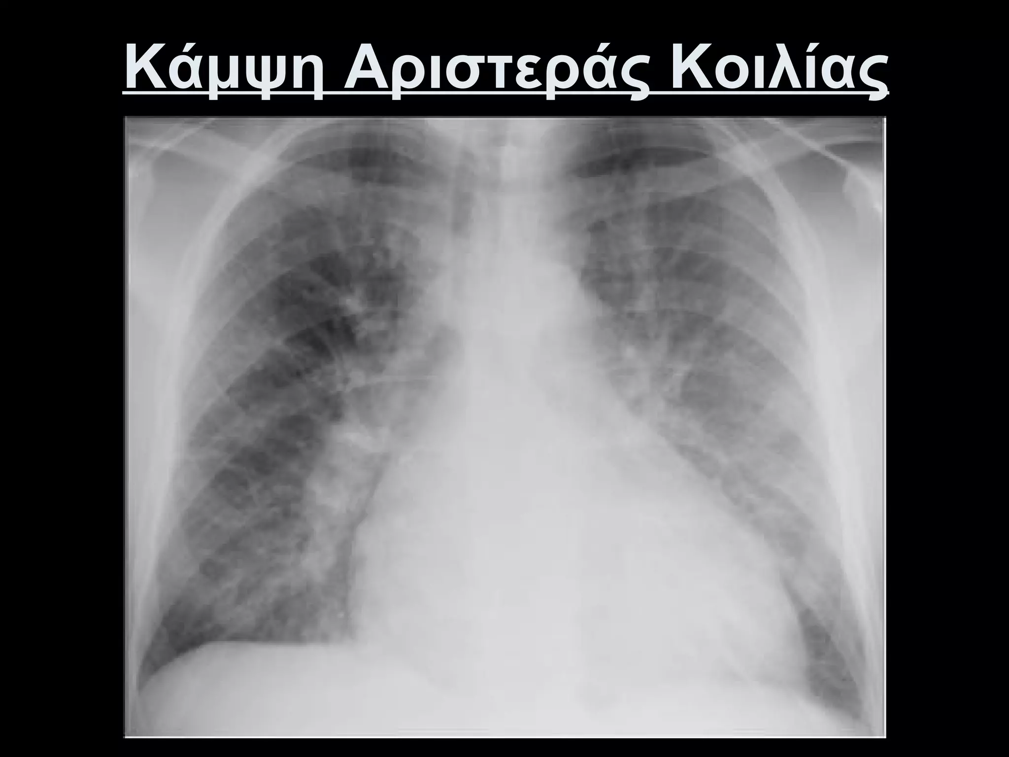 Eρμηνεία ακτινογραφίας θώρακος | PPT