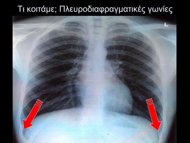 Eρμηνεία ακτινογραφίας θώρακος | PPT