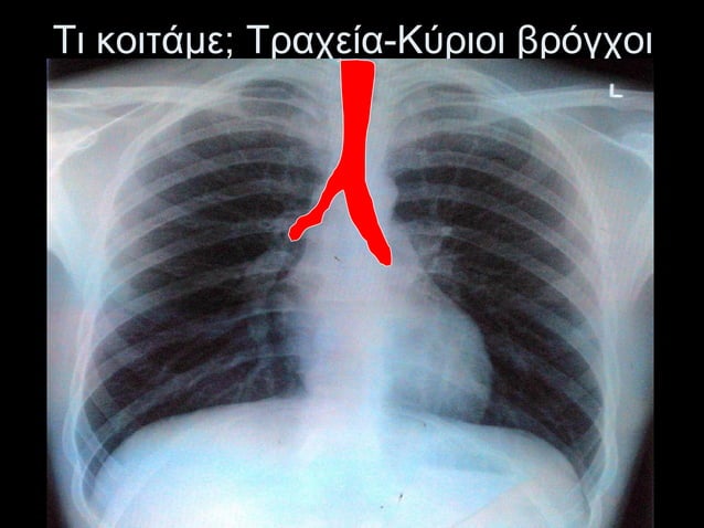 Eρμηνεία ακτινογραφίας θώρακος | PPT