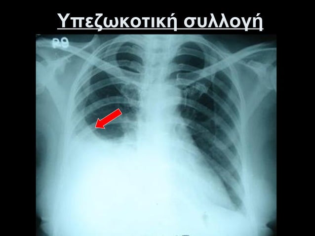 Eρμηνεία ακτινογραφίας θώρακος | PPT