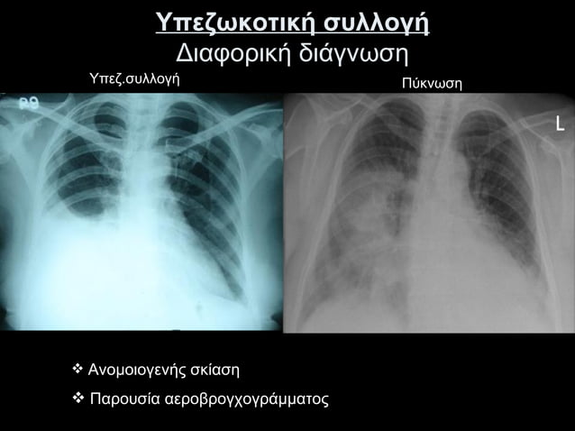Eρμηνεία ακτινογραφίας θώρακος | PPT