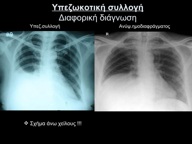 Eρμηνεία ακτινογραφίας θώρακος | PPT