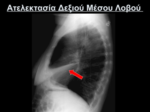 Eρμηνεία ακτινογραφίας θώρακος | PPT