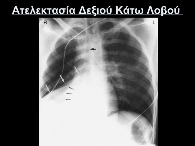 Eρμηνεία ακτινογραφίας θώρακος | PPT