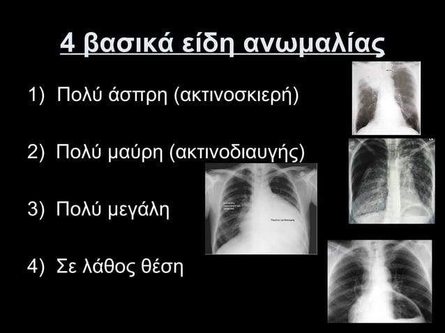 Eρμηνεία ακτινογραφίας θώρακος | PPT