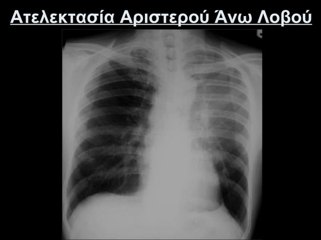 Eρμηνεία ακτινογραφίας θώρακος | PPT