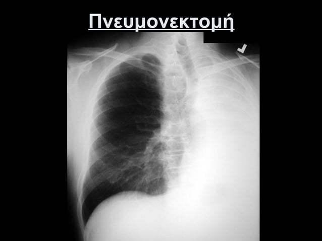 Eρμηνεία ακτινογραφίας θώρακος | PPT