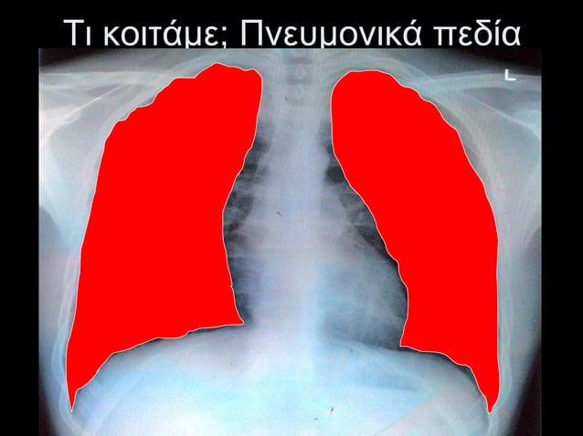 Eρμηνεία ακτινογραφίας θώρακος | PPT