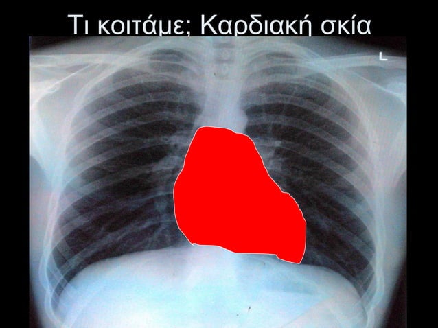 Eρμηνεία ακτινογραφίας θώρακος | PPT