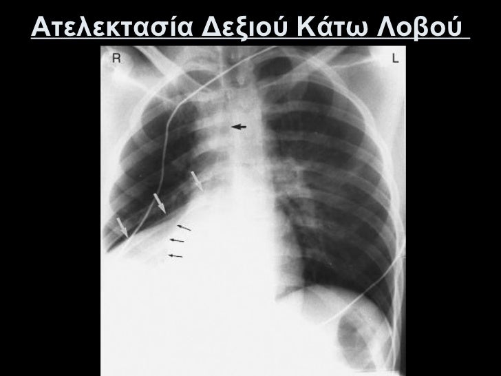 Eρμηνεία ακτινογραφίας θώρακος