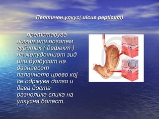 Улкус Вентрикули - Ulcus Ventriculi | PPT