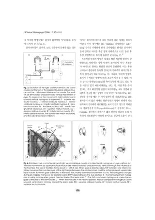 후반고리관 양성돌발성 두위현훈의 진단과 치료 | PDF