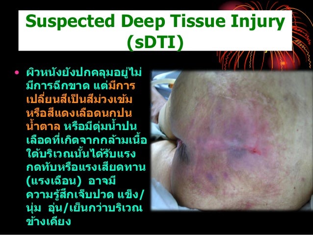 แผลกดทับ