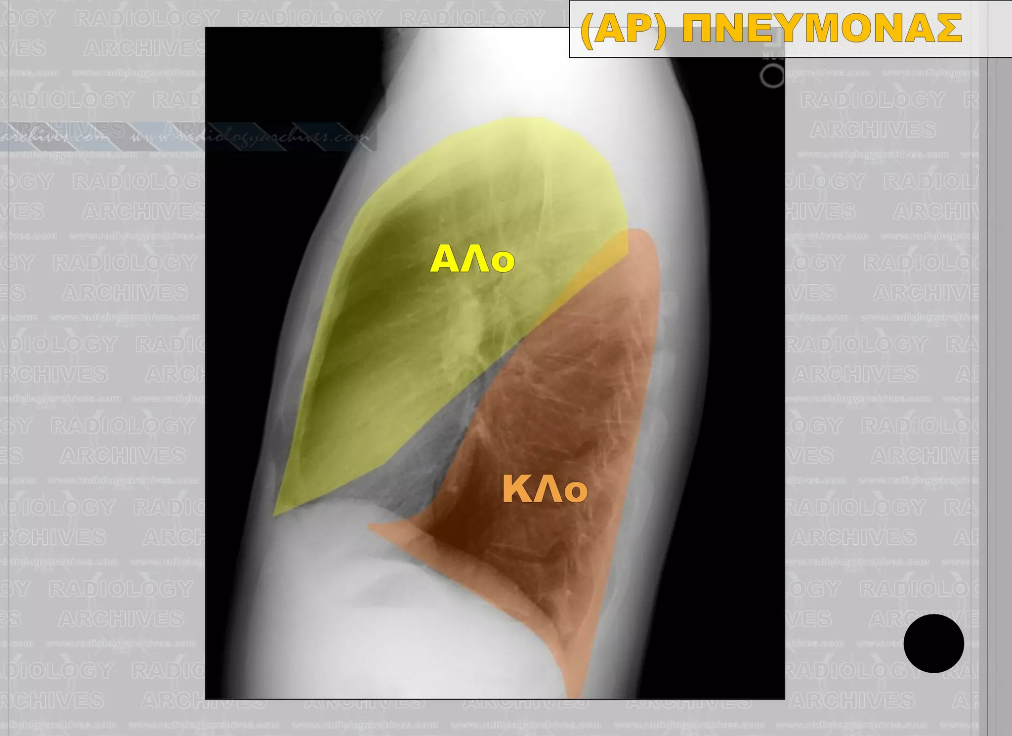 Ανατομία Θώρακα - Ακτινολογική Προσέγγιση | PDF