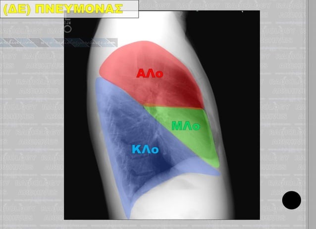 Ανατομία Θώρακα - Ακτινολογική Προσέγγιση | PDF