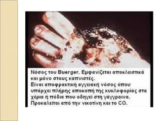 ΒΛΑΒΕΡΕΣ ΣΥΝΕΠΕΙΕΣ ΤΟΥ ΚΑΠΝΙΣΜΑΤΟΣ | PPT