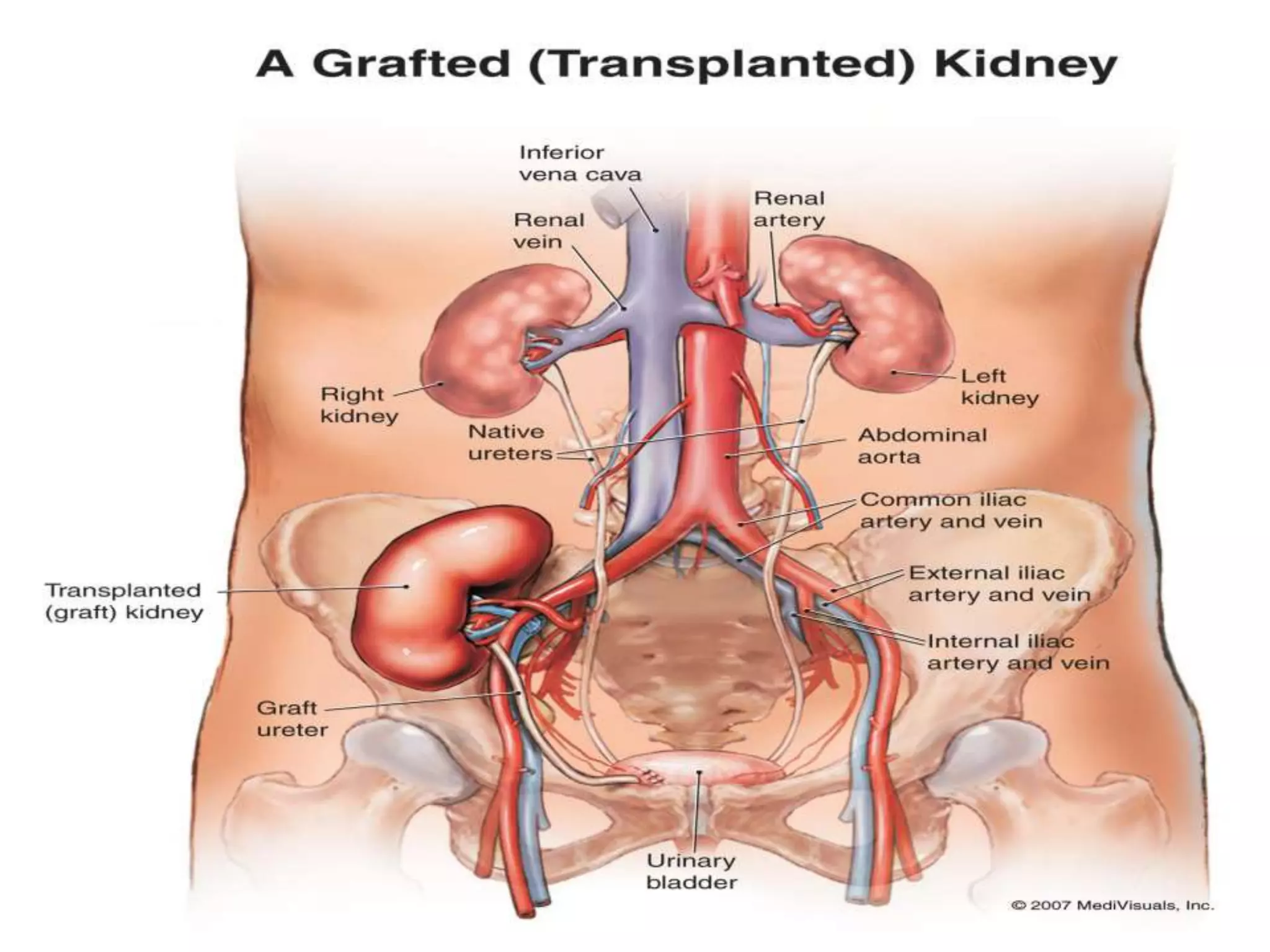 Renal transplantation | PPT