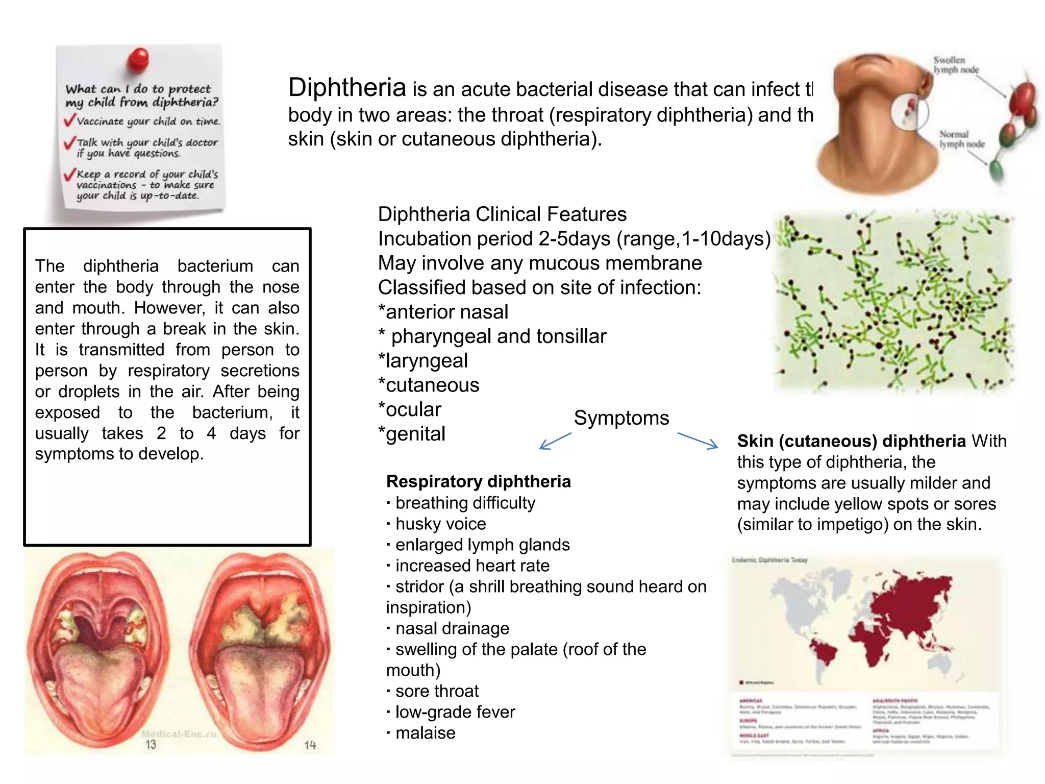 Diphtheria | PPTX