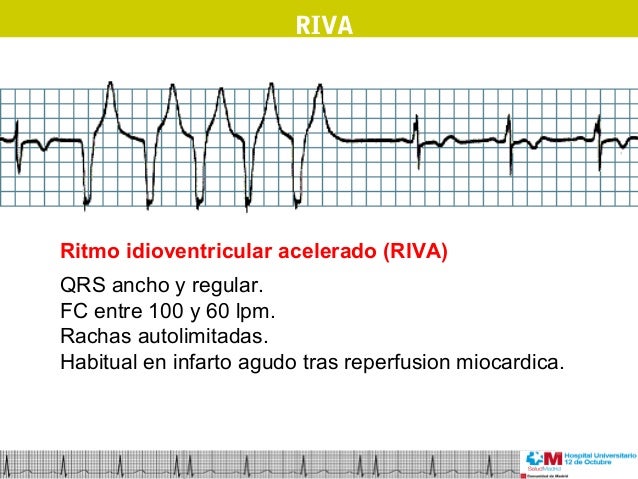 ECG. Día 3. Taquiarritmias