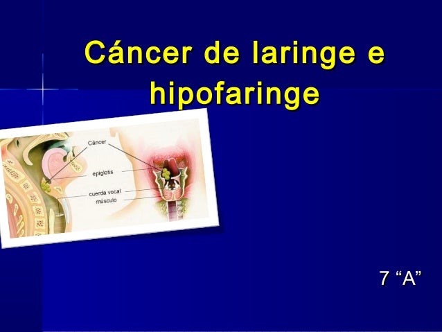 Cancer De Laringe
