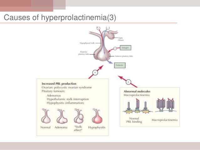 Hyperprolactinemia work up