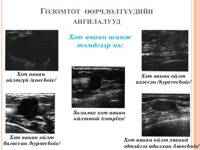 хөхний хэт авиан оношлогоо