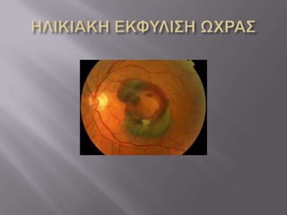 Ηλικιακή Εκφύλιση Ώχρας | PPT