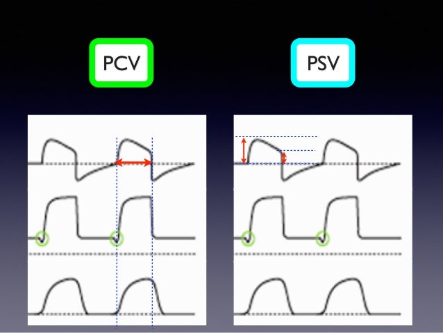 人工呼吸 モードの違い