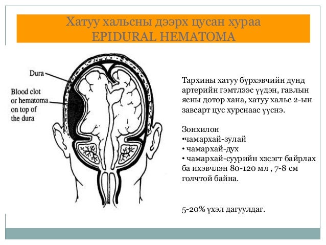 гавал тархины гэмтэл