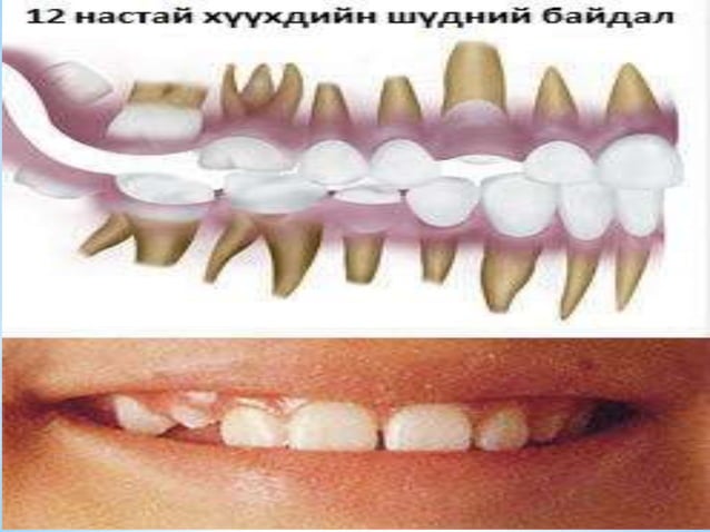 сүүн шүд болон байнгын шүдний онцлог