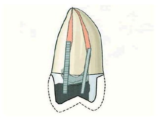 dental post and core | PPTX