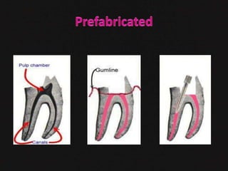 dental post and core | PPTX