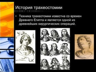 Tracheostomy | PPTX | Lung and Respiratory Health | Diseases and Conditions