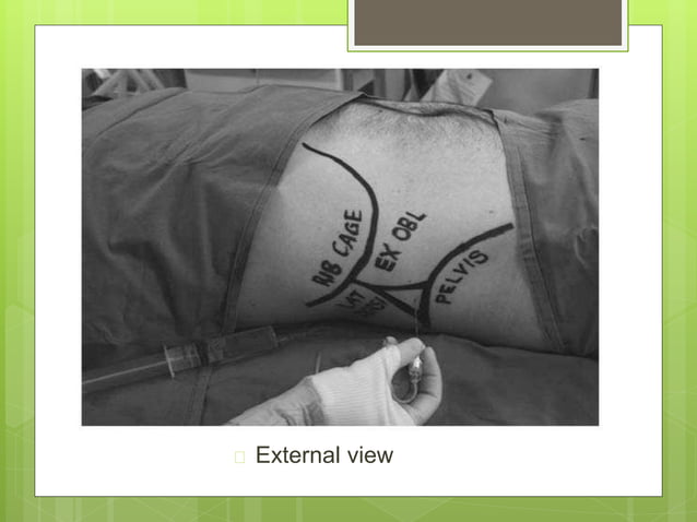 Lumbar triangle(Petit’s triangle) and it’s anatomical characteristics ...