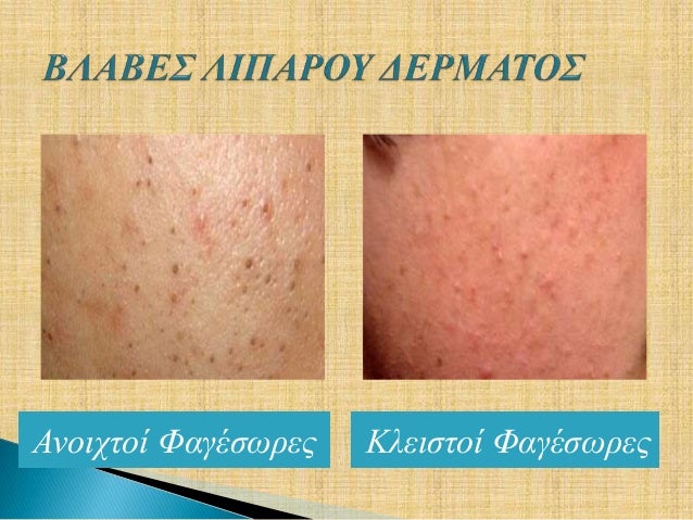 τυποι δερματοσ