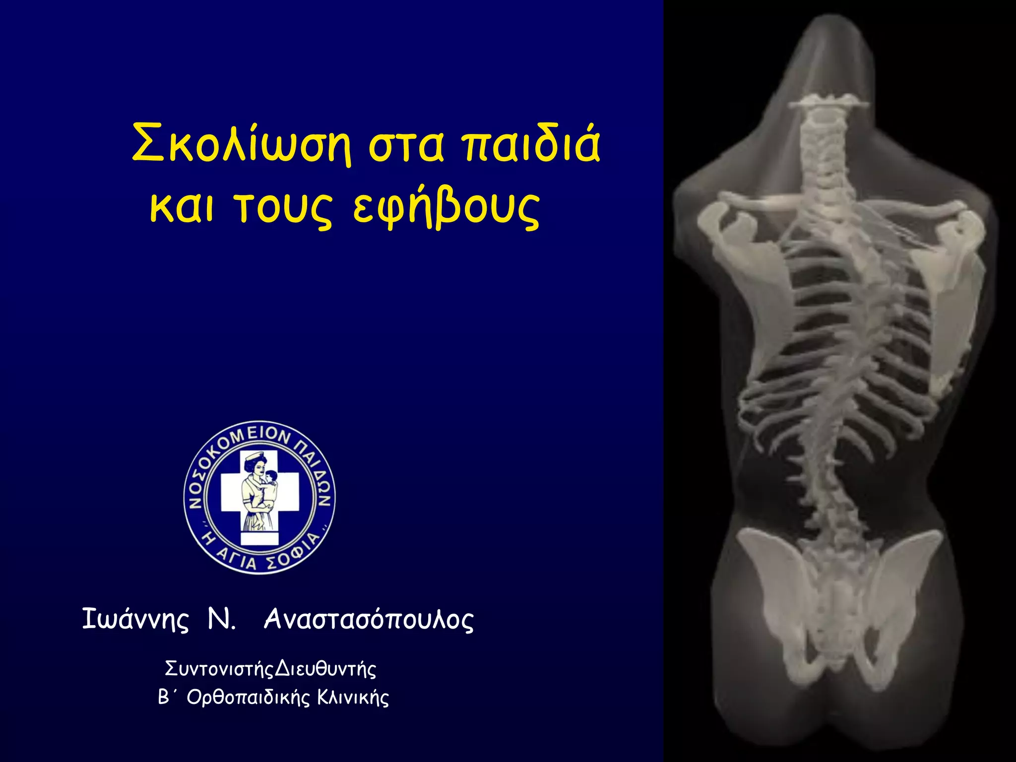 Σκολίωση στα Παιδιά & στους Εφήβους | PPT